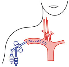 haemodialysis, arteriovenous graft, central vein catheterization