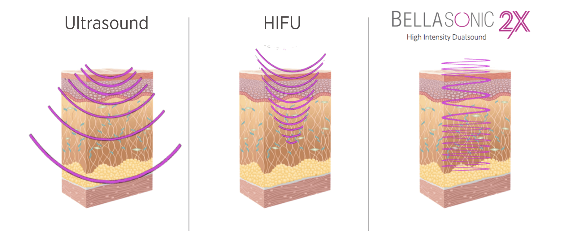Bellasonic 2X Cell Regeneration Treatment - Virtus Aesthetics Intelligence