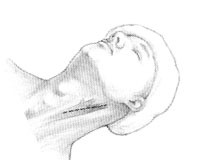 Carotid disease, stroke, carotid stenosis, carotid endarterectomy