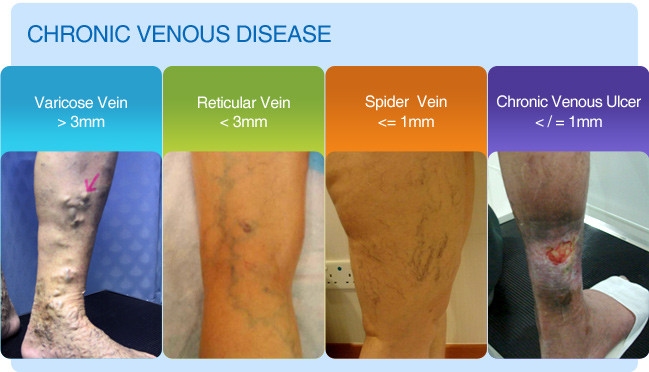 venous disease, chronic venous disease, varicose veins, injection ...